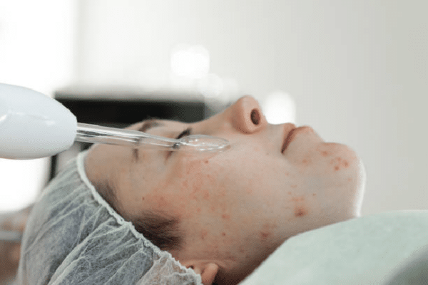 The Acne Landscape – Accure for Acne