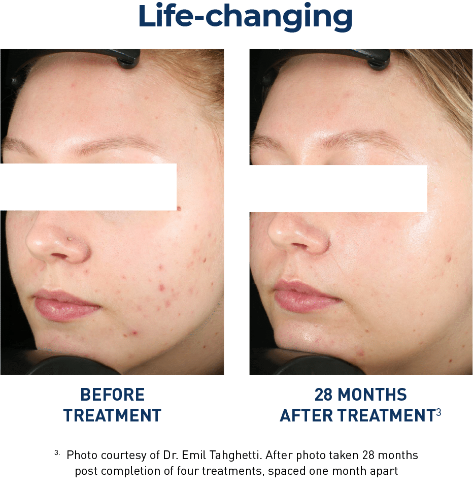 Before & After – Accure for Acne