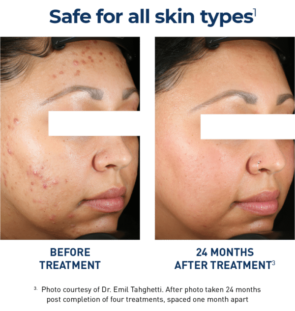 Before & After – Accure for Acne